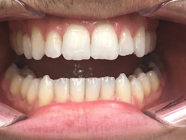 Invisalign Teeth Straightening | Dental Blog - Holistic Dental Centre
